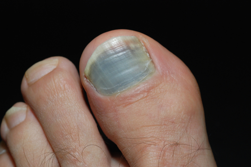 Ingrown Toenails and Other Nail Related Injuries - Caruso Foot & Ankle