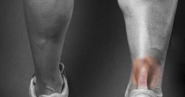 Achilles Tendonitis | Symptoms and Treatment | Caruso Foot and Ankle