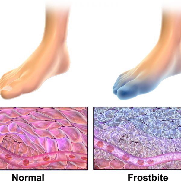 Frostbite symptoms, prevention and treatment | Caruso Foot & Ankle