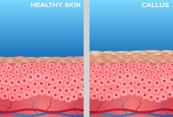 Calluses and Corns: Eastside Podiatry PLLC: Board Certified Podiatrist ...