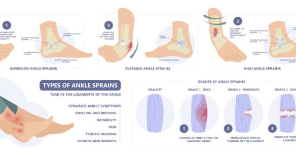 About Ankle Sprains | Caruso Foot & Ankle