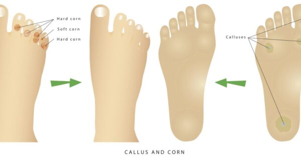 About Calluses and Corns | Caruso Foot & Ankle