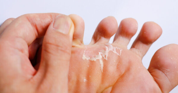 About Athlete's Foot | Caruso Foot & Ankle